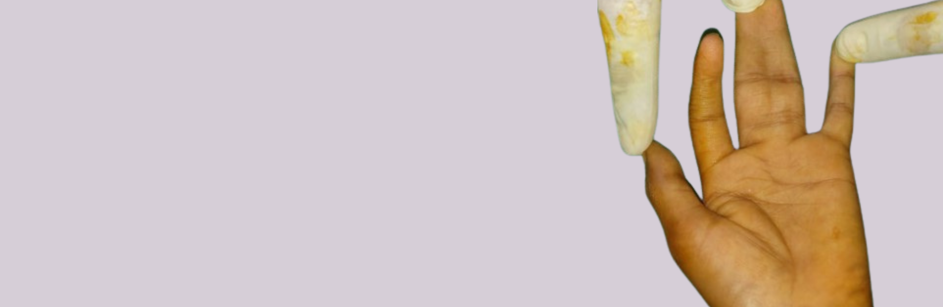 Hand Deformities Treatment in Ahmedabad | Congenital Hand Surgery