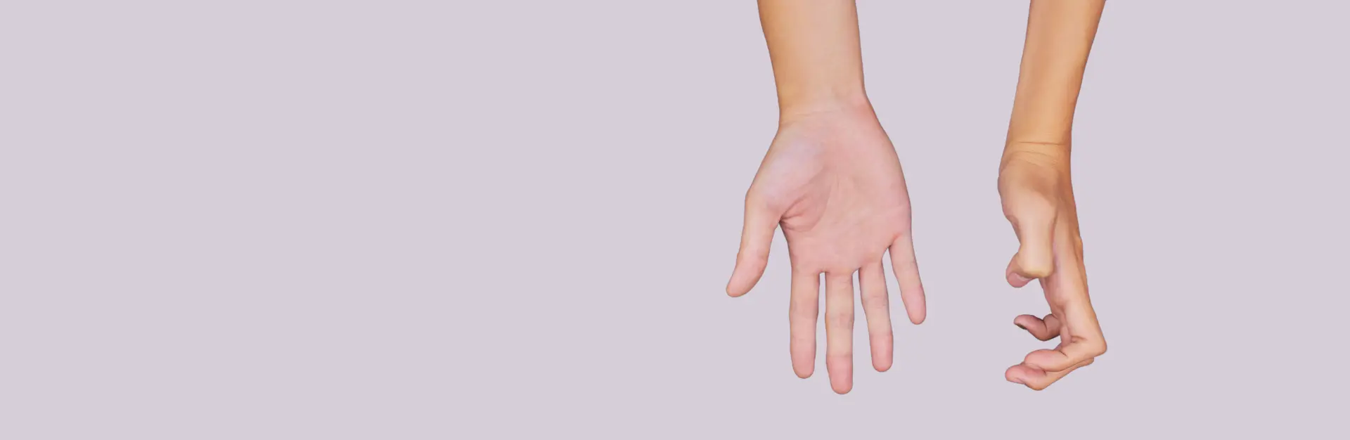 Expert Hand Deformities Treatment - Cutis Hospital Ahmedabad