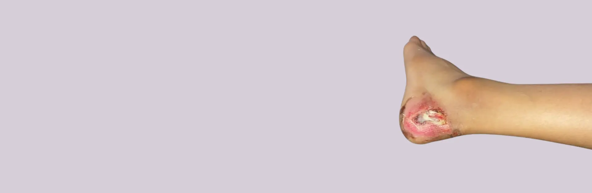 Lower Limb Injury Surgery in Ahmedabad | Leg, Thigh & Foot Trauma Care