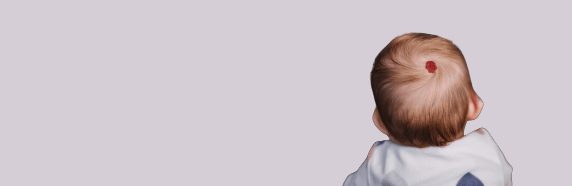 Birthmark Removal Surgery in Ahmedabad | Cutis Hospital