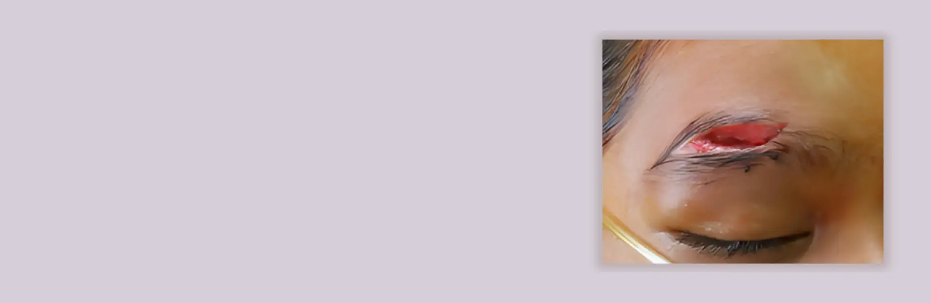 Eyelid Laceration Treatment in Ahmedabad | Trauma Experts
