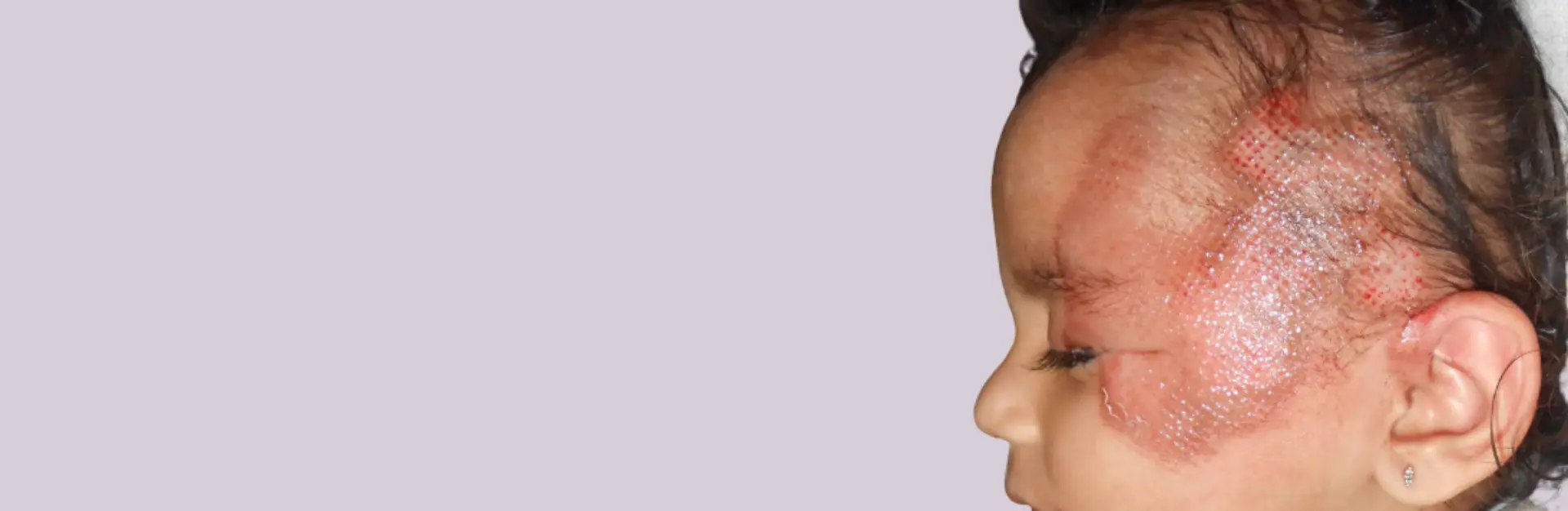 Skin Abrasion On Face