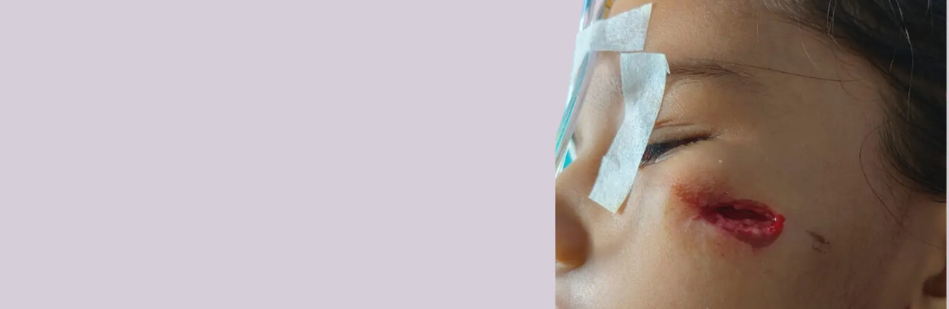 Facial Laceration Treatment in Ahmedabad | Cutis Hospital