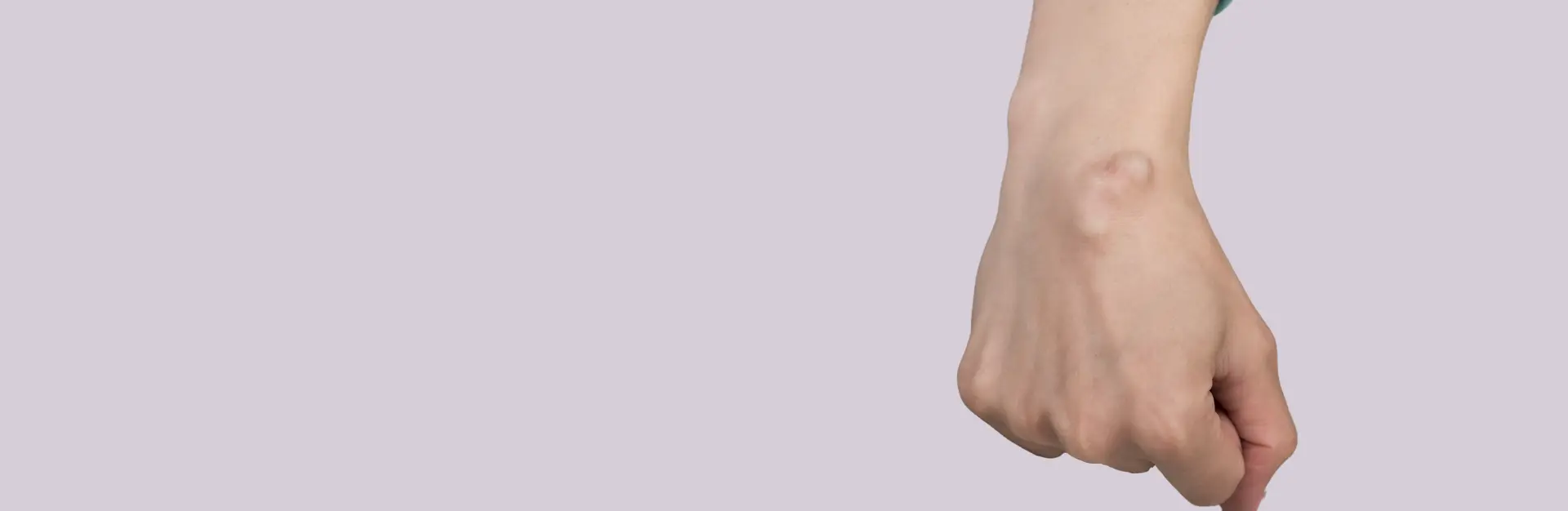 Hand Tumor Treatment in Ahmedabad | Cutis Hospital