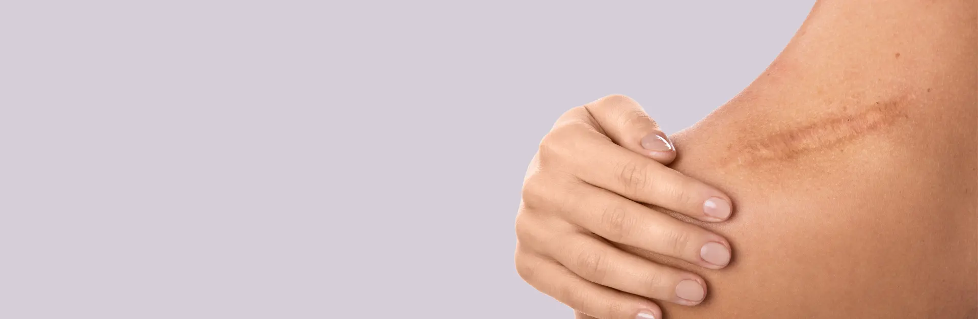 Hypertrophic Scar Treatment in Ahmedabad | Cutis Hospital