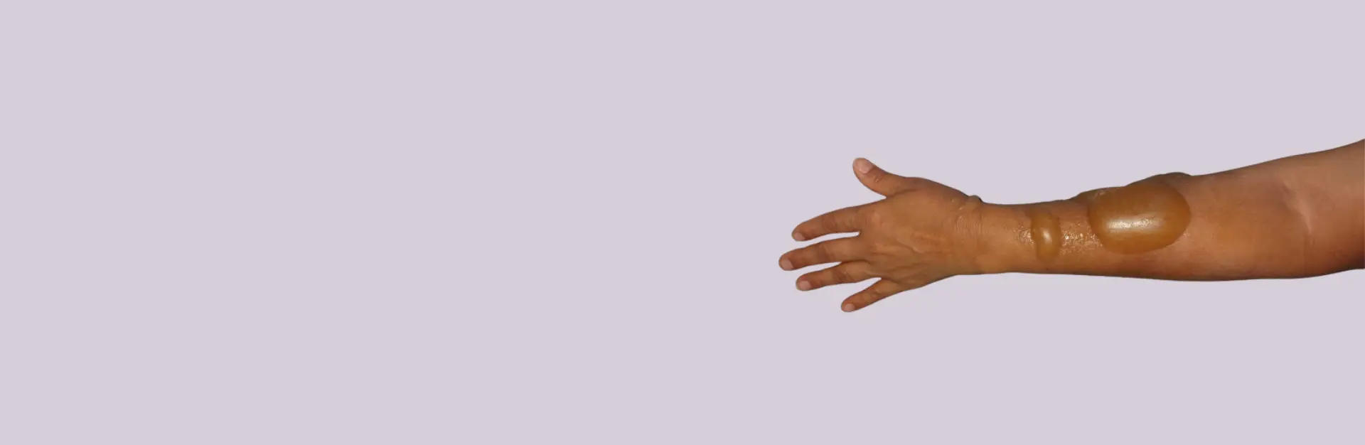 Advanced Burns & Scalds Treatment in Ahmedabad | Cutis Hospital