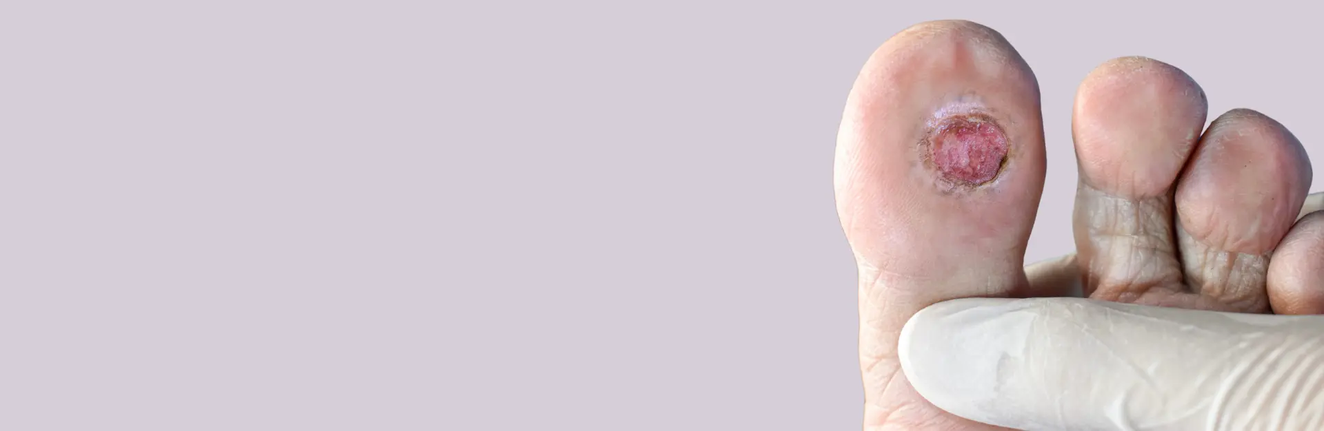 Diabetic Foot Infections Treatment in Ahmedabad, India | Cutis Hospital