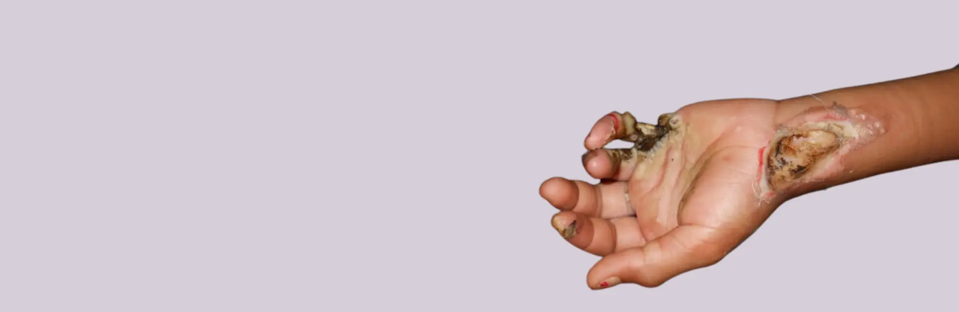 Electrical Burns Treatment in Ahmedabad | Cutis Hospital