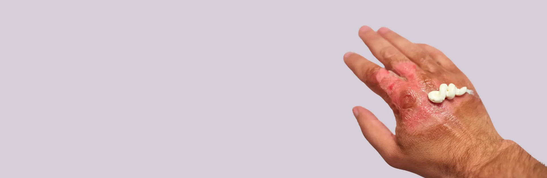 Personalized Friction Burns Treatment - Cutis Hospital Ahmedabad