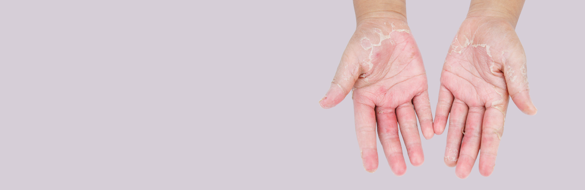 Hand Infection Treatment in Ahmedabad | Cutis Hospital